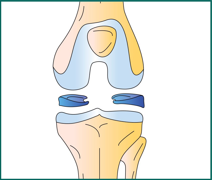 Traitement de l’arthrose à Paris – Les menisques – Dr Mylle