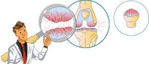 La chondropathie - Cabinet du Dr Mylle